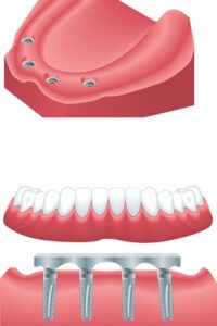 The All-on-4 concept at complete tooth loss - CheapDentalImplants